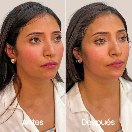 Marcación mandibular en Holaglow